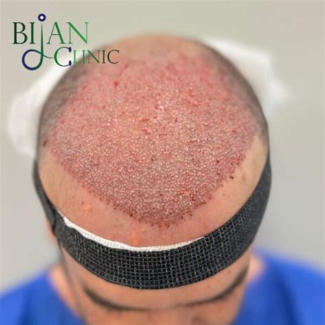 Alopecia Hair Transplants Best In Australia