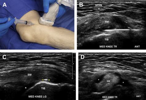 Ultrasound Guided Knee Procedures Physical Medicine And
