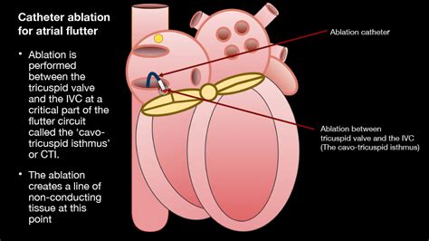 Atrial Flutter Ablation Associate Professor Sandeep Prabhu