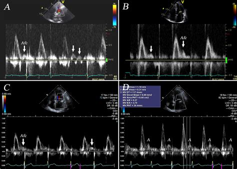 Association Between Doppler Flow Of Atrial Fibrillatory Contraction And
