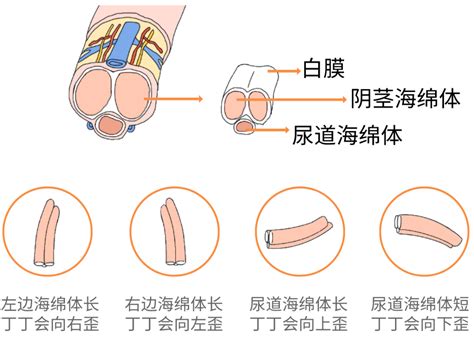 为什么有的人丁丁是直的，有的是弯的？科普健康160资讯网