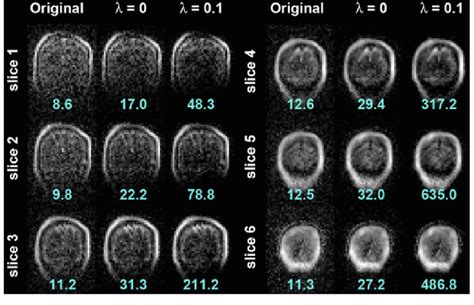 Brain Images Reconstructed By The Regularized Sense Method With No Download Scientific Diagram