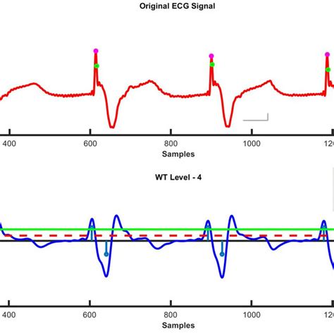 Top Original Ecg Signal From Mit Bih File 104 With Annotation And Download Scientific Diagram