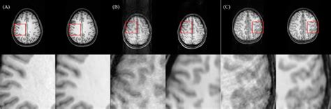 Figure 9 From Motion Correction For Brain Mri Using Deep Learning And A Novel Hybrid Loss