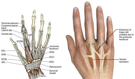 Extensory Tendon Zones Rehabilitation Following Thumb Extensor Tendon