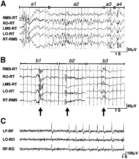 Eeg And Ecog Recordings In Epm2a 7 7 Mice A The Eeg In Null