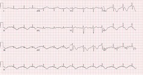 Electrocardiogram Changes Showing Deep T Wave Inversions After Lab Download Scientific Diagram