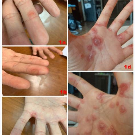 A C Polymorphic Rash Units With The Appearance Of Concentric Circles Download Scientific