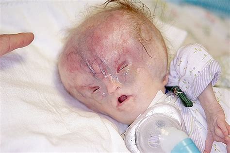 Neonatales Progeroid Syndrom