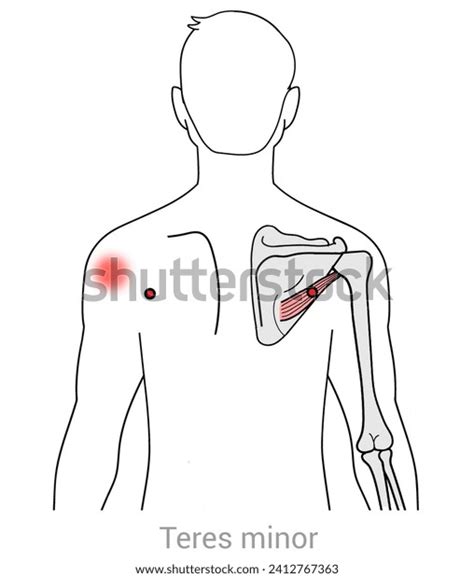 Myofascial Trigger Point Teres Minor Muscle Stock Illustration 2412767363 Shutterstock