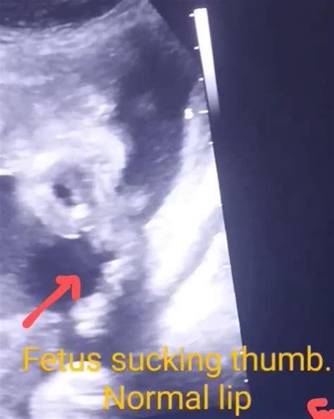 Dr Frantz Charles On Linkedin Normal Lip Vs Cleft Lip And Palate