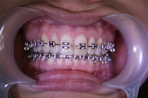 Clear Braces With Purple Bands