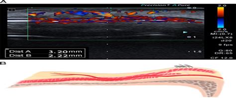 Ultrathin Supratrochlear Artery Cutaneous Branch Flaps For L Journal Of Craniofacial Surgery