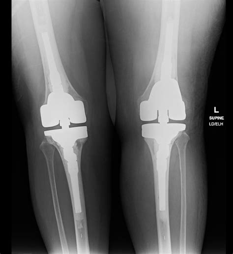 Revision Knee Replacement Surgery Melbourne — Mr Sam Patten Melbourne
