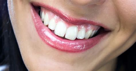 Smile Aesthetics For Big Gums And Small Teeth Zenit Dent