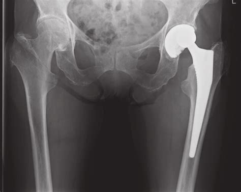 Pelvic X Ray Of A Liner Dissociation With An Enlocated But