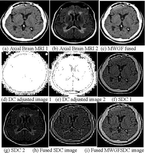 Figure 8 From Hybrid Multimodal Medical Images Fusion Combining Mwgf With Dc Coefficient Scaling