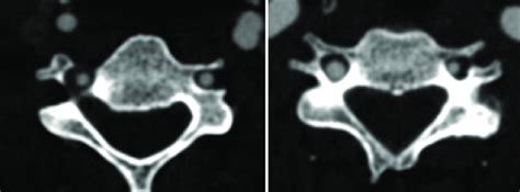 A Cta Showing Vertebral Artery Located In The Medial Part Of