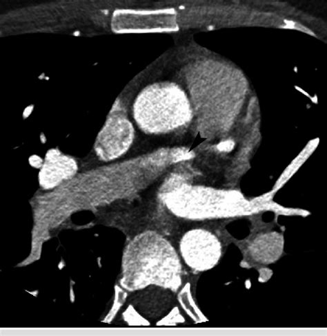 Anomalous LCX Artery From RPA Axial Coronary CT Angiogram Image Download Scientific Diagram