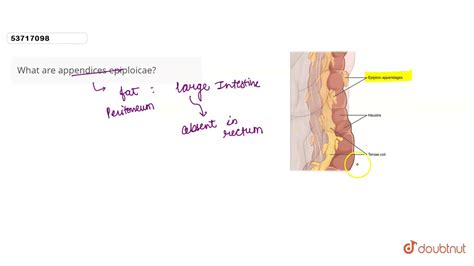 Appendices Epiploicae Epiploic Appendagitis Of The Vermiform