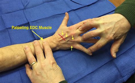 Extensor Digitorum Communis Edc Exam Anatomic Structures At Risk
