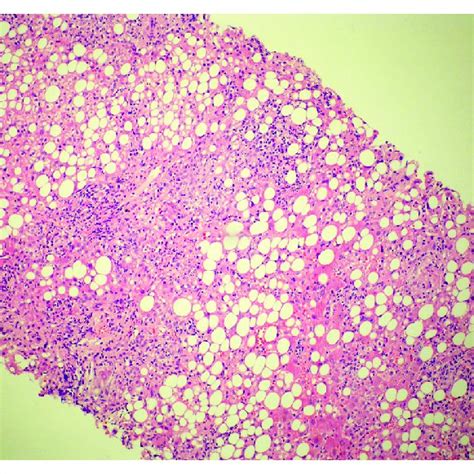 Intraparenchymal Macrovesicular Steatosis Grade 3 And Granulomatous