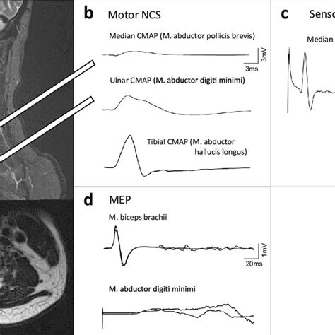 Lesion In Upper Motor Neuron At Maria Cardenas Blog