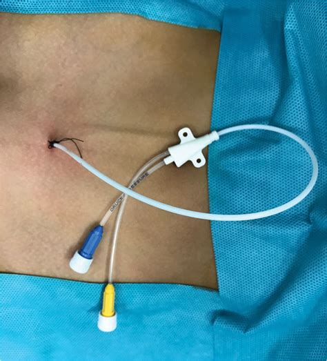 Urodynamic Testing Procedure