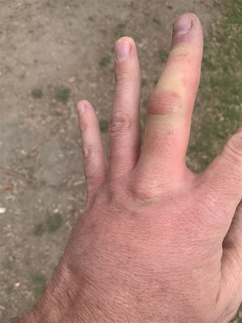 Red Wasp Sting Swelling Wasp Sting Heres What You Need To Know