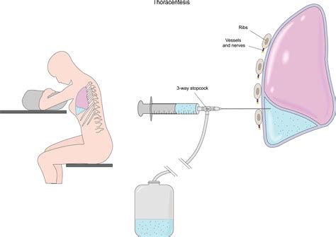 Ce Activity Thoracentesis Nurses