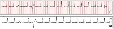 ECG Signal Before A And After B Processing By Developed Application Download Scientific
