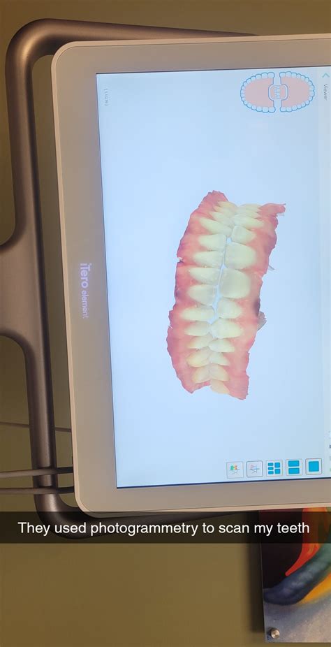 Visiting The Dentist For The First Time In A While And They Made A Model Of My Teeth With