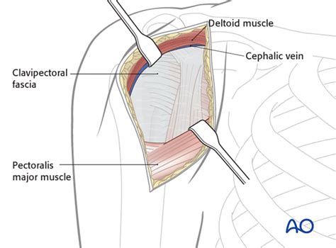 Deltopectoral Approach To The Scapula