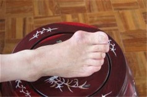 痛风石初期症状图片 有来医生