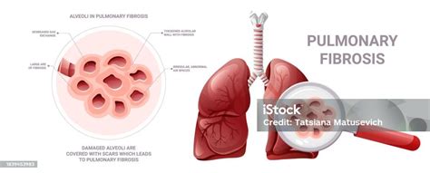 Alveoli In Pulmonary Fibrosis Under Magnification Vector Illustration Isolated On White