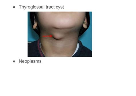Lingual Thyroid Nodule Pptx