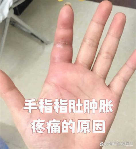 手指指肚肿胀疼痛的原因