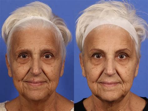 Forehead Botox Before And After