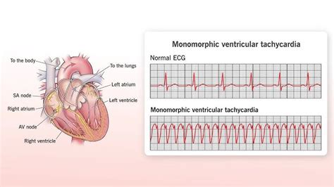 Ventricular Tachycardia Causes Symptoms Diagnosis