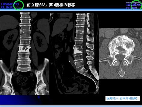 骨転移 ct