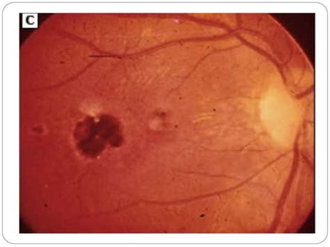 Torch Infection In Neonate Newborn Pptx Pregnancy Reproductive Health