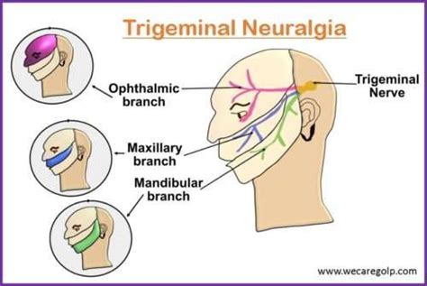 Trigeminal Neuralgia We Care