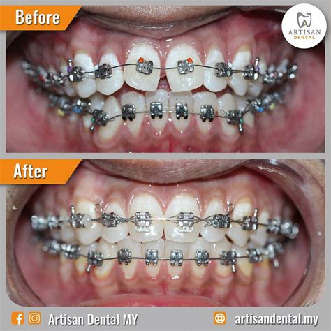 Self Ligating Braces Artisan Dental