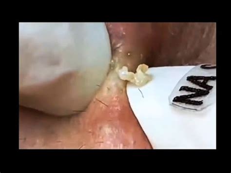 Breathtaking Pimple Extraction Satisfying Skincare Routine Skincareroutine Pimples Acne
