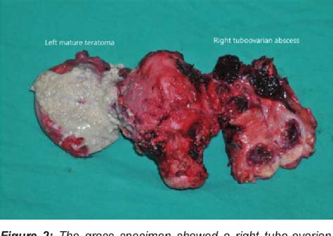 Figure 1 From 232 G2018 032 Laparoscopic Resection Of An Extensive Layout 1 Semantic Scholar