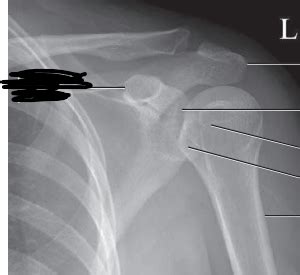 AP Internal Rotation Shoulder B Diagram Quizlet