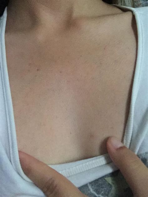 Please Anything Helps Pics Hyperpigmentation Reddark Marks