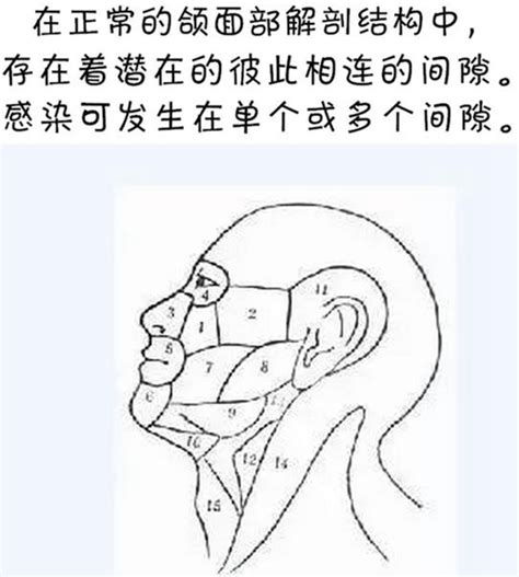 间隙感染 咬肌间隙 颊间隙 大山谷图库