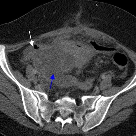 CT Scan Coronal View Of The Abdomen And Pelvis Showing An Appendiceal Download Scientific