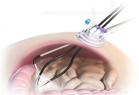 Single Incision Laparoscopy Anthony Siow